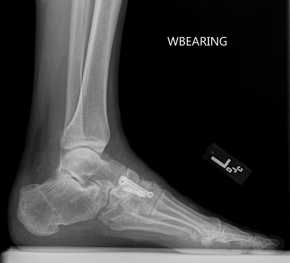 Treating An Active Hiker With A Gastroc Recession And A Midfoot Osteotomy