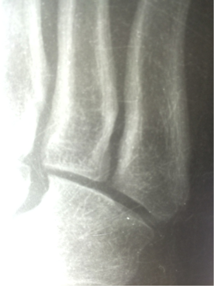 Pearls On Diagnosing And Treating Iselin Disease In Children