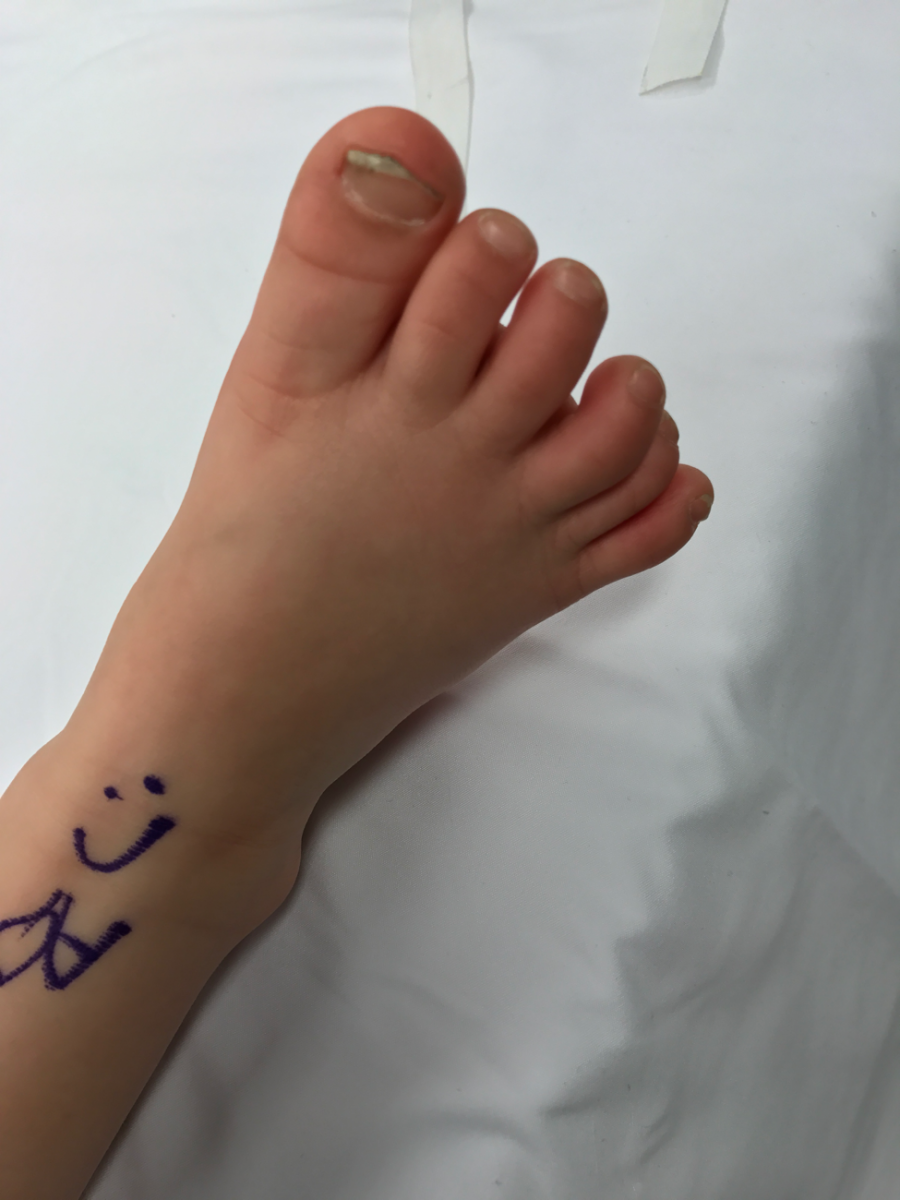 Deciding Which Digit To Remove In Patients With Polydactyly