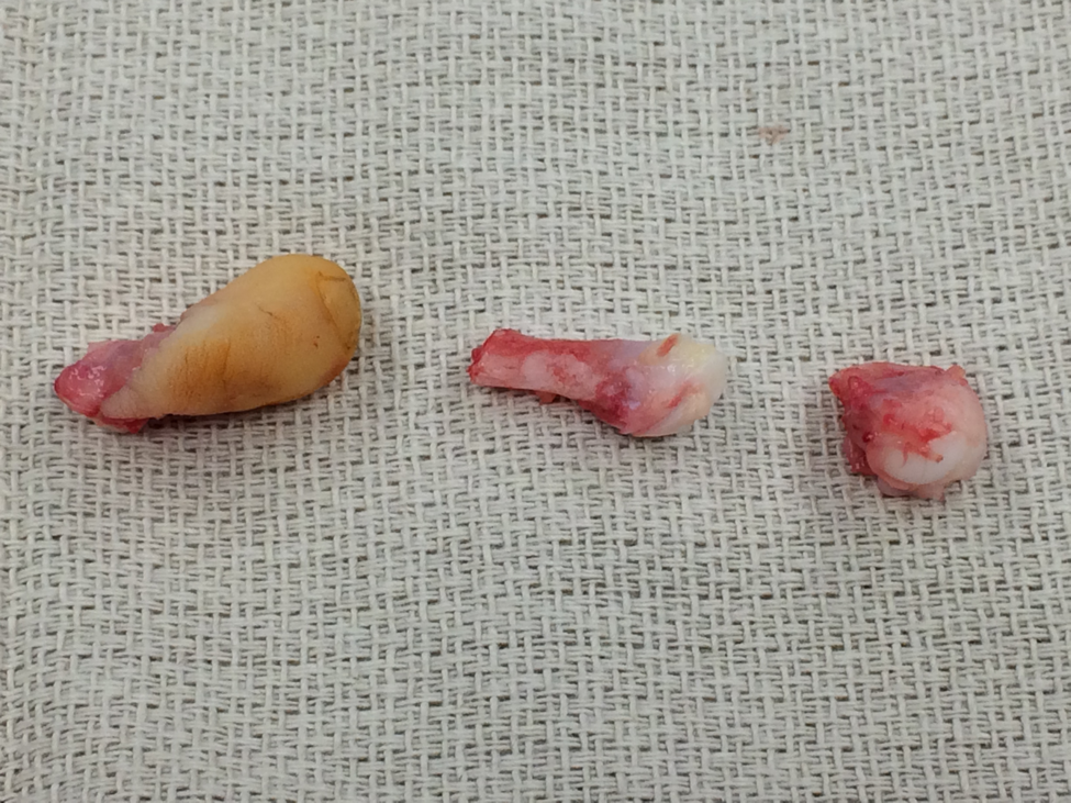 Deciding Which Digit To Remove In Patients With Polydactyly