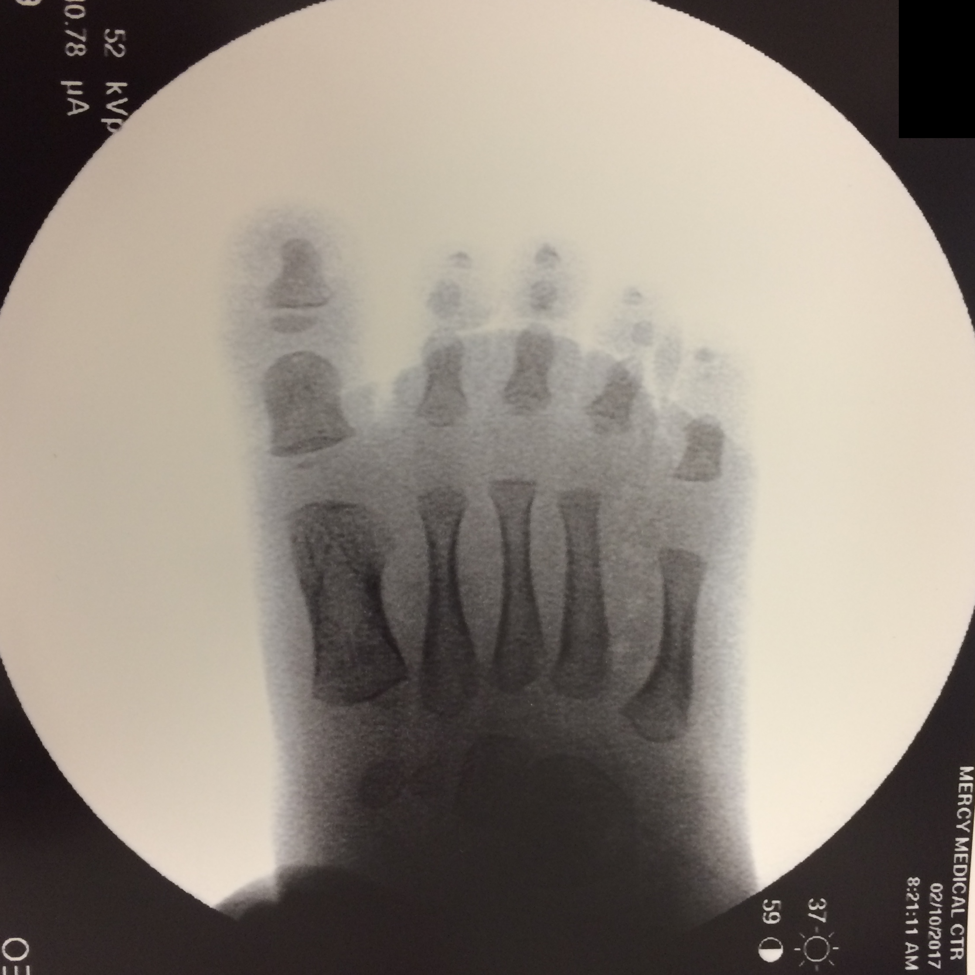 Deciding Which Digit To Remove In Patients With Polydactyly
