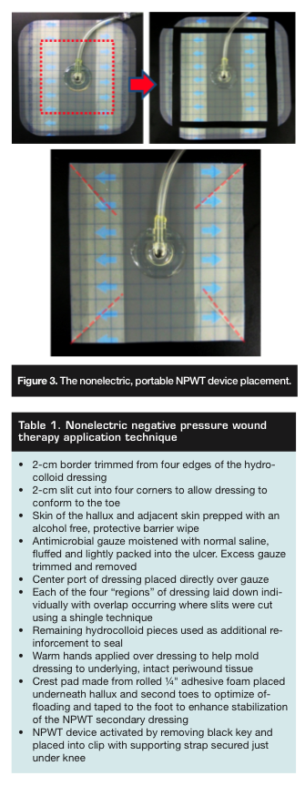 Treatment of a diabetic hallux ulcer with ultraportable negative ...