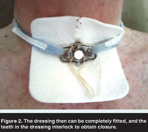 Pearls for Practice: A Novel Tracheostomy Dressing: Extension of a ...