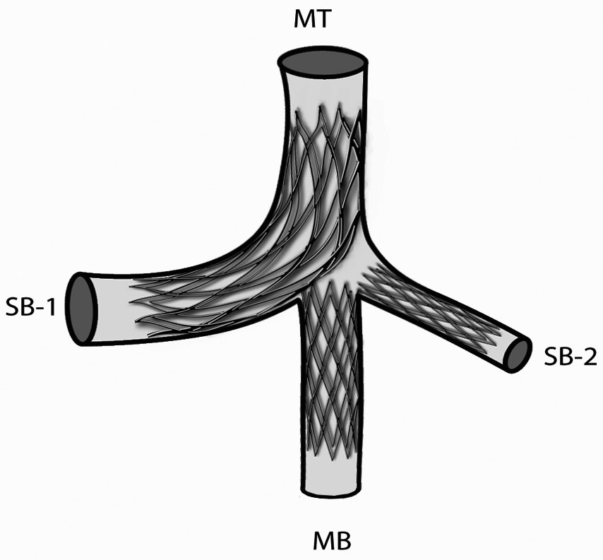 Long-Term Outcomes in Treating Left Main Trifurcation Coronary Artery ...