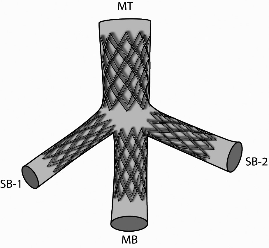 Long-Term Outcomes in Treating Left Main Trifurcation Coronary Artery ...