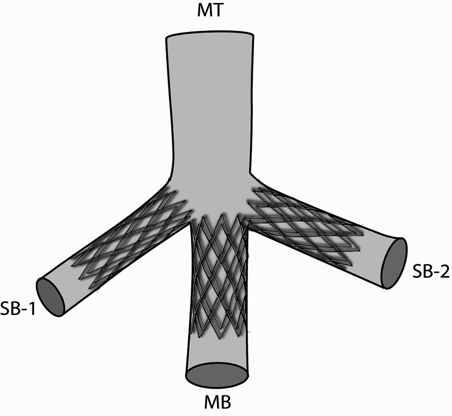 Long-Term Outcomes in Treating Left Main Trifurcation Coronary Artery ...