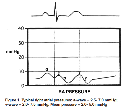 The ABCs of A to V: Right Atrial/ Left Atrial (PCW) Pressures