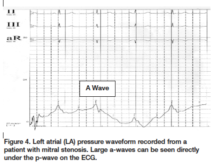 The ABCs of A to V: Right Atrial/ Left Atrial (PCW) Pressures