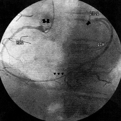 Collateral Coronary Circulation In The Absence Of Obstructive Coronary