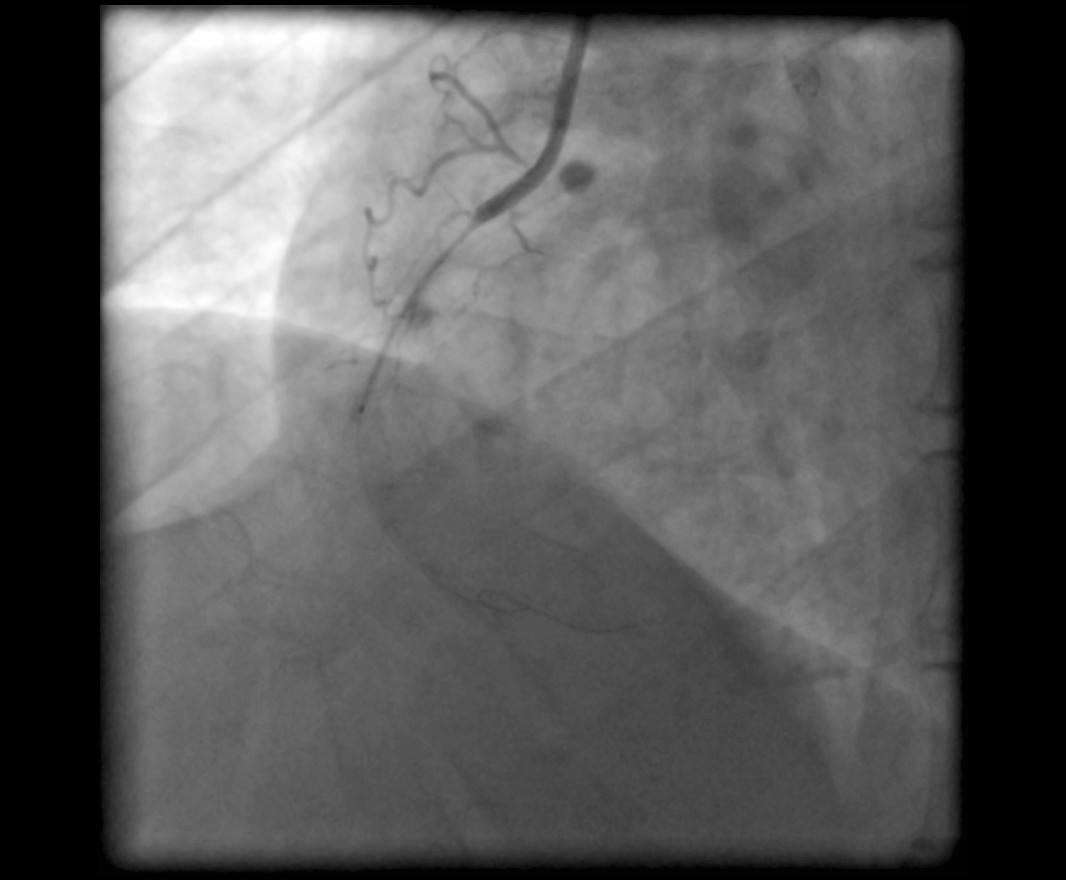 Crossing a Chronic Total Occlusion Using Combination Therapy with ...