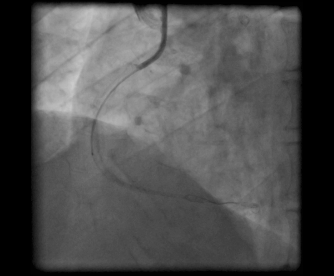 Crossing a Chronic Total Occlusion Using Combination Therapy with ...