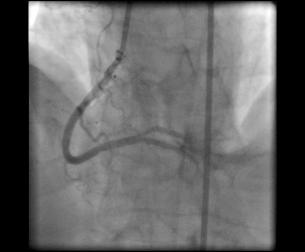 Crossing a Chronic Total Occlusion Using Combination Therapy with ...