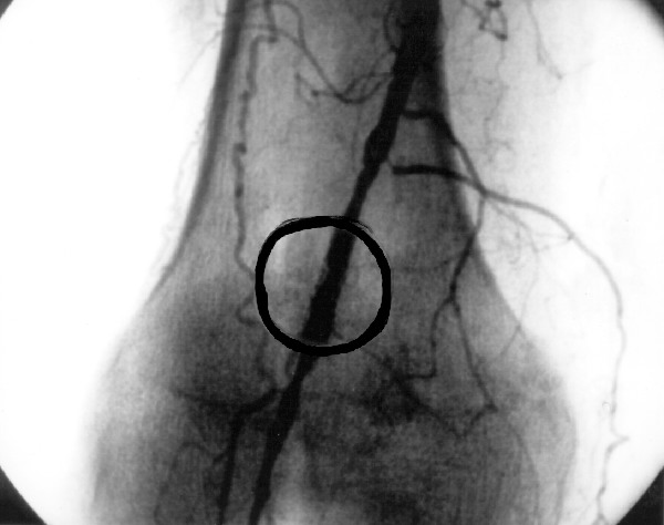 Percutaneous Femoral Artery Angioplasty with Stent-in-Stent Technique ...