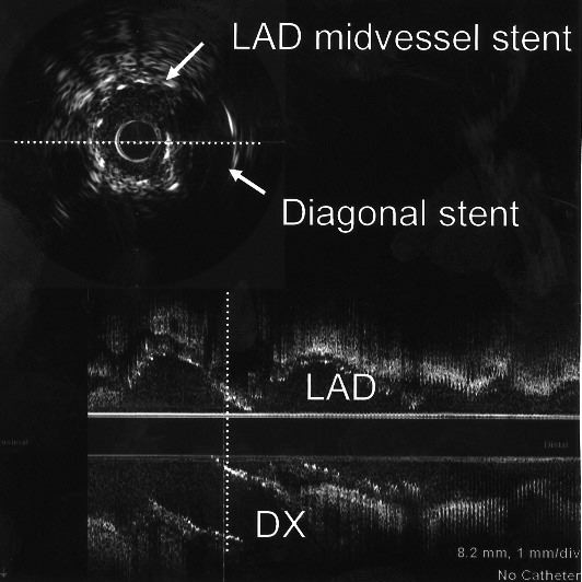 Treatment of Complex LAD-Diagonal Bifurcation Disease Using Paclitaxel ...
