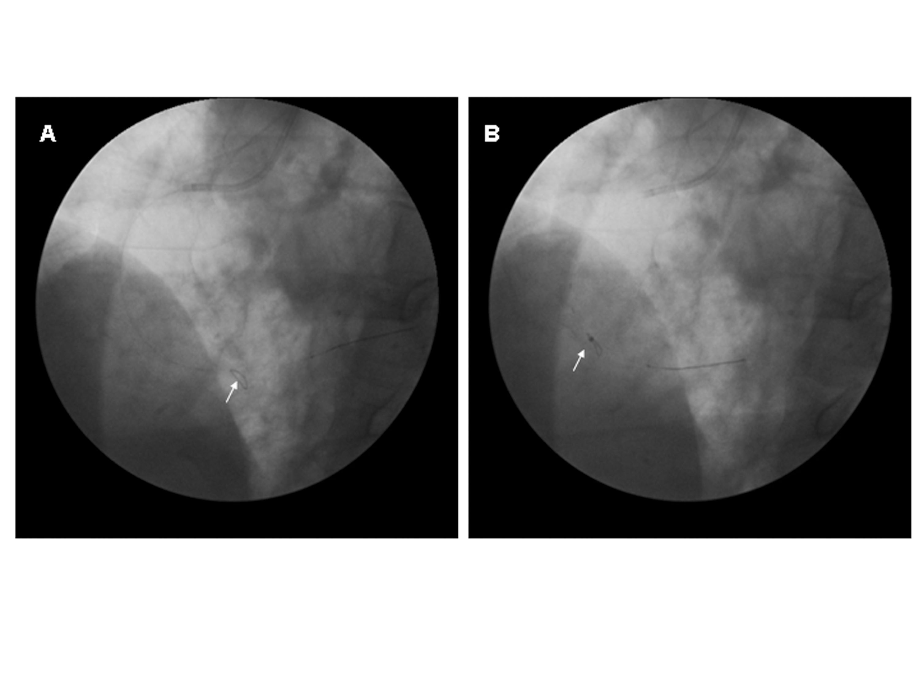 A Novel Method of Clot Extraction Using a FilterWire EX‚Ñ¢ in Acute ...