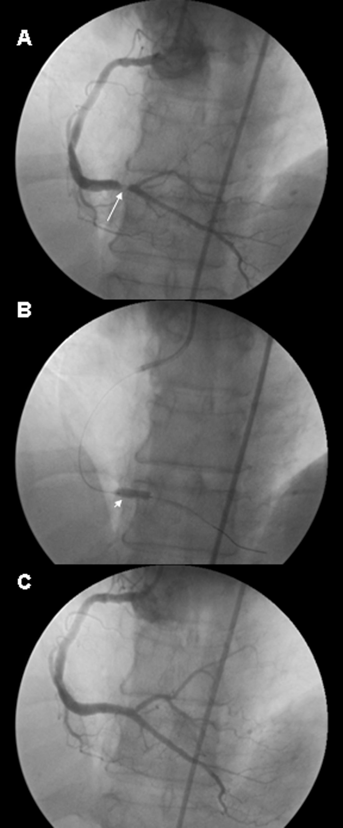 A Novel Method of Clot Extraction Using a FilterWire EX‚Ñ¢ in Acute ...