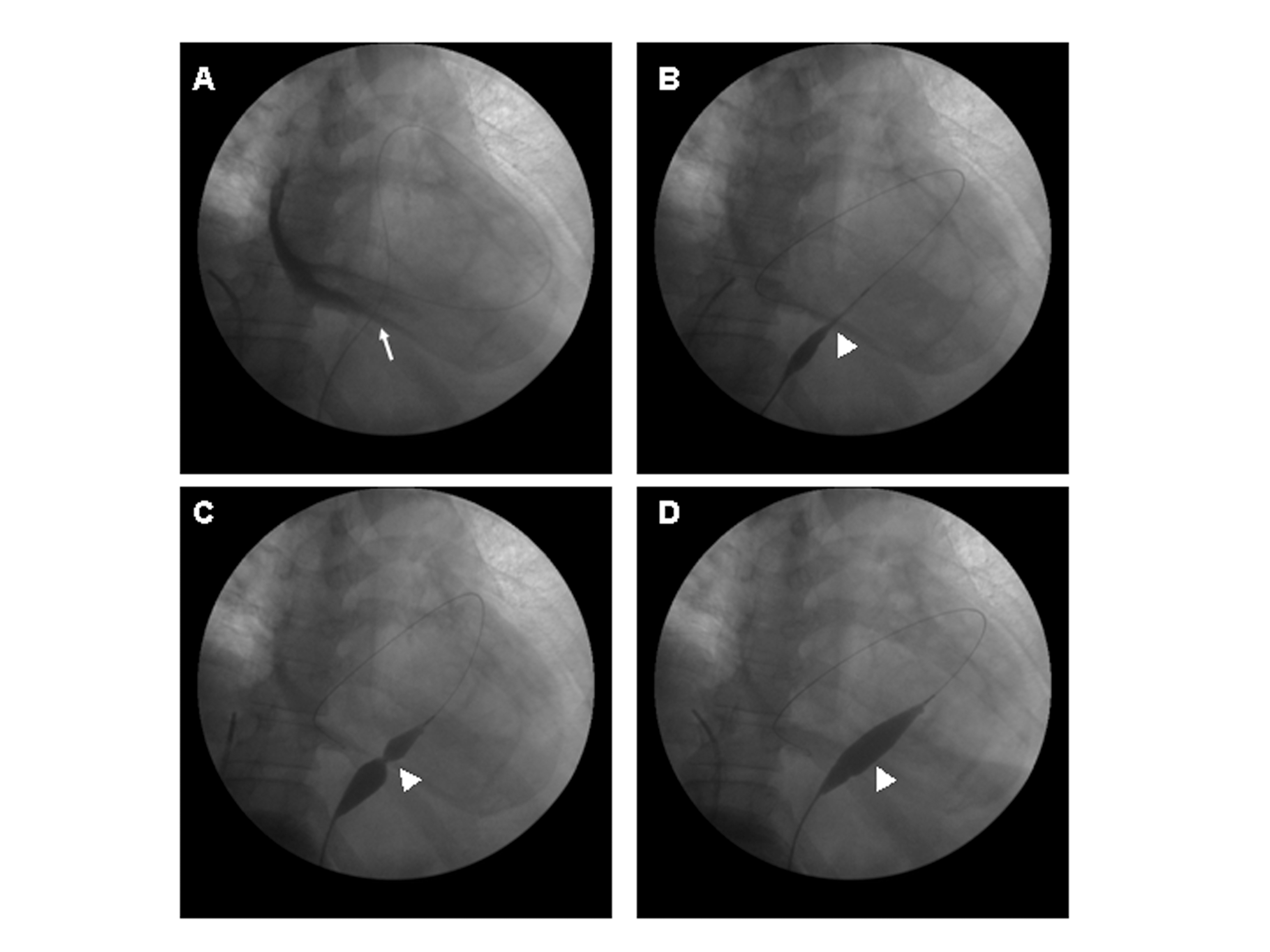Percutaneous Balloon Pericardiotomy for the Treatment of Infected ...