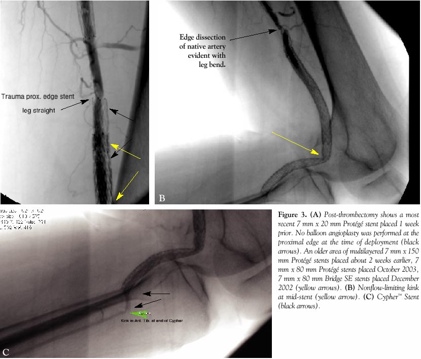 Stents In Arteries Legs
