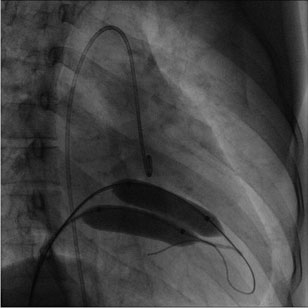 Percutaneous Balloon Valvuloplasty of Coexisting Mitral and Tricuspid ...