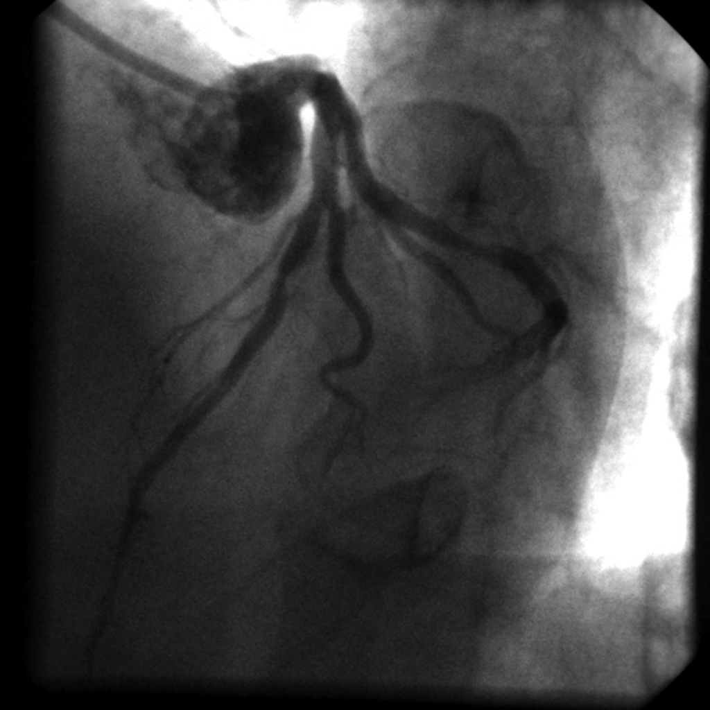Transradial Treatment of Bifurcation Coronary Disease Using the Multi ...
