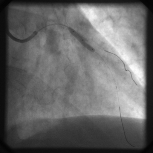 Transradial Treatment of Bifurcation Coronary Disease Using the Multi ...