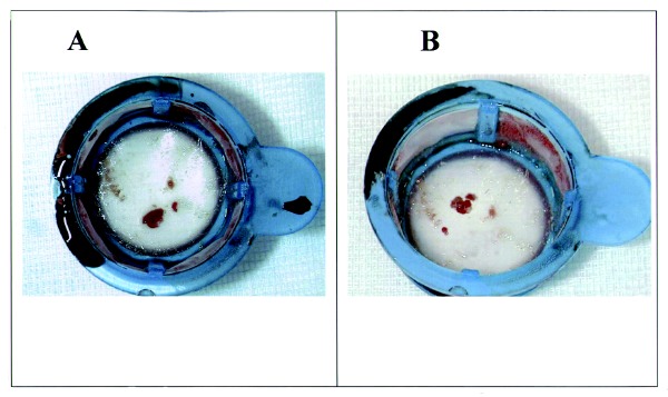 Distal Embolization During Directional Coronary Atherectomy