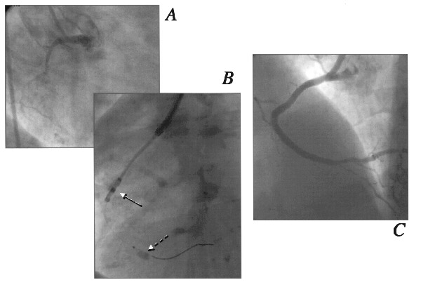 Distal Embolization During Directional Coronary Atherectomy