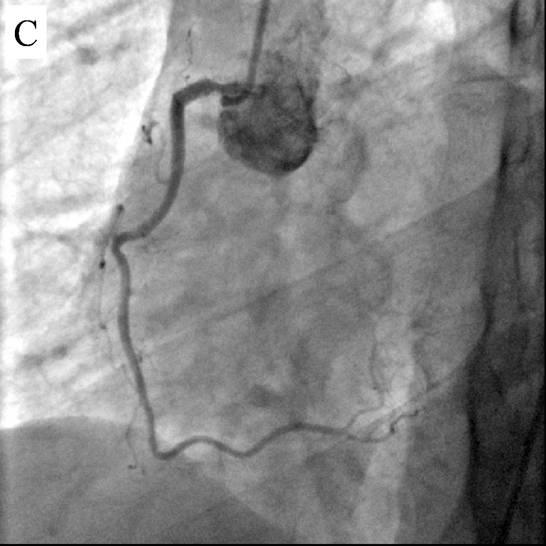 Side-Strut Stenting Technique for the Treatment of Aorto-Ostial In ...