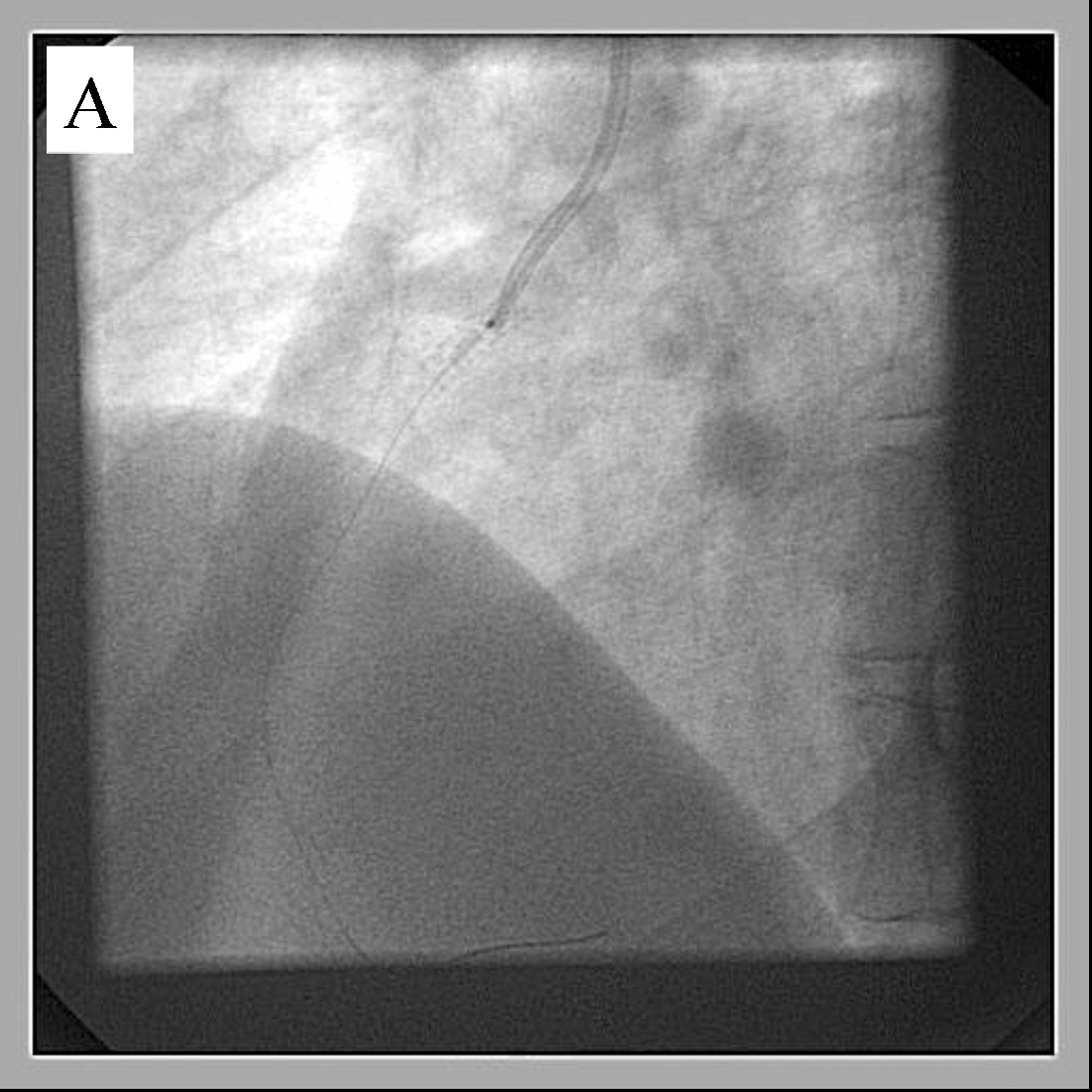Side-Strut Stenting Technique for the Treatment of Aorto-Ostial In ...