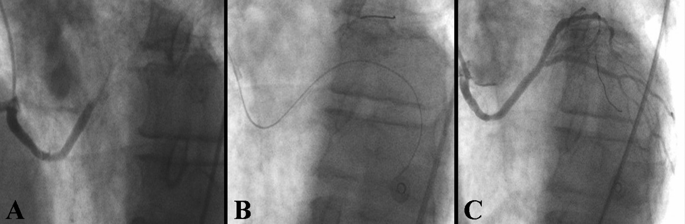 Use of a Second, ‚ÄúBuddy‚Äù Wire During Percutaneous Coronary ...