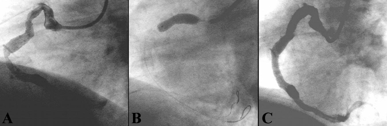 Use of a Second, ‚ÄúBuddy‚Äù Wire During Percutaneous Coronary ...