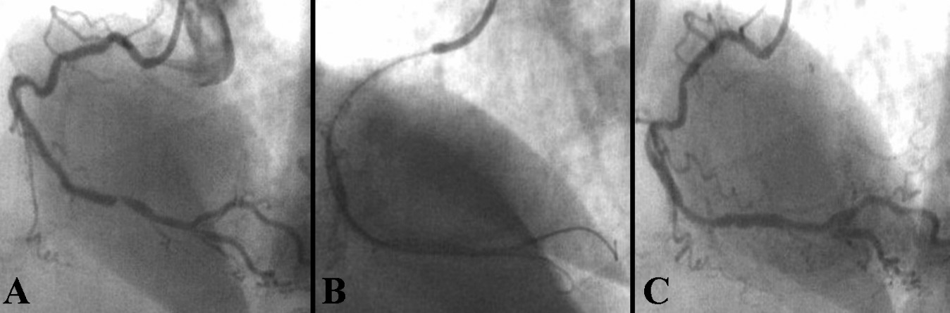 Use of a Second, ‚ÄúBuddy‚Äù Wire During Percutaneous Coronary ...