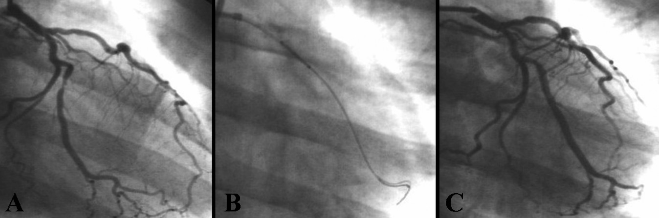 Use of a Second, ‚ÄúBuddy‚Äù Wire During Percutaneous Coronary ...