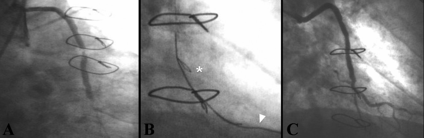 Use of a Second, ‚ÄúBuddy‚Äù Wire During Percutaneous Coronary ...