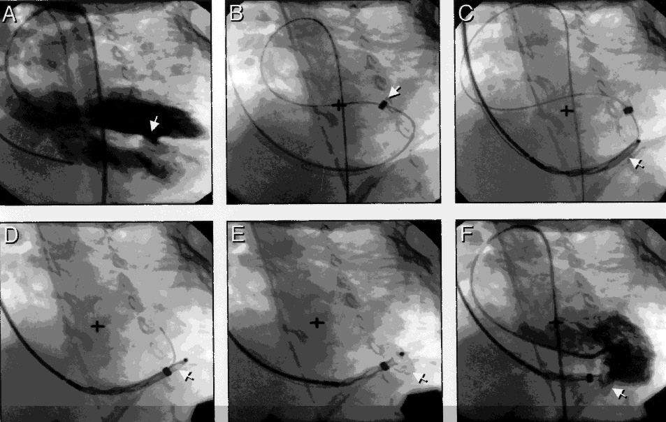 Transcatheter Closure of Congenital and Acquired Muscular Ventricular ...