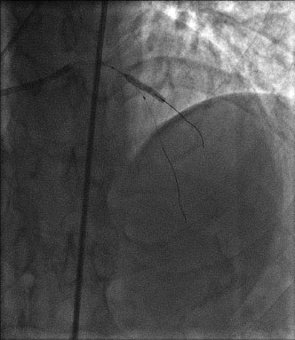 DK Crush (Double-Kissing and Double-Crush) Technique for Treatment of ...