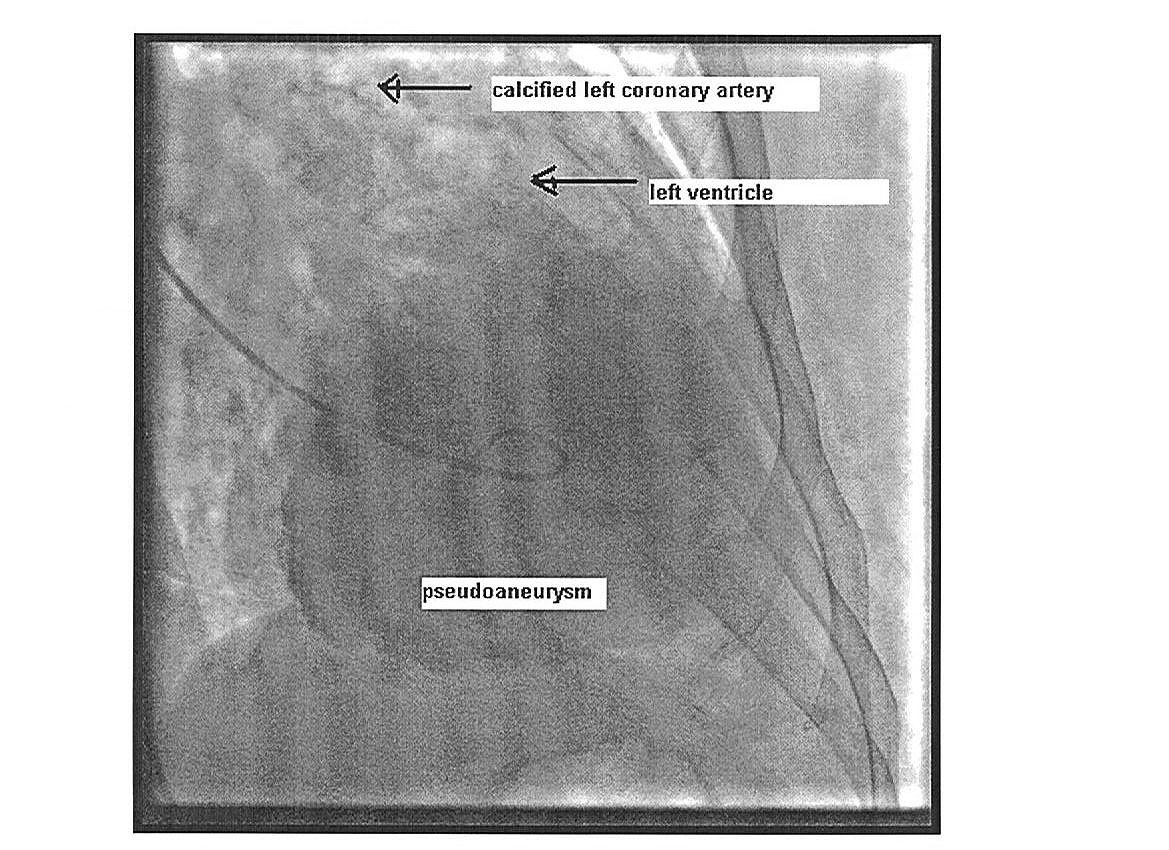 Global Akinesis: Inadvertent Left Ventricular ‚ÄúPseudoaneurysmogram‚Äù