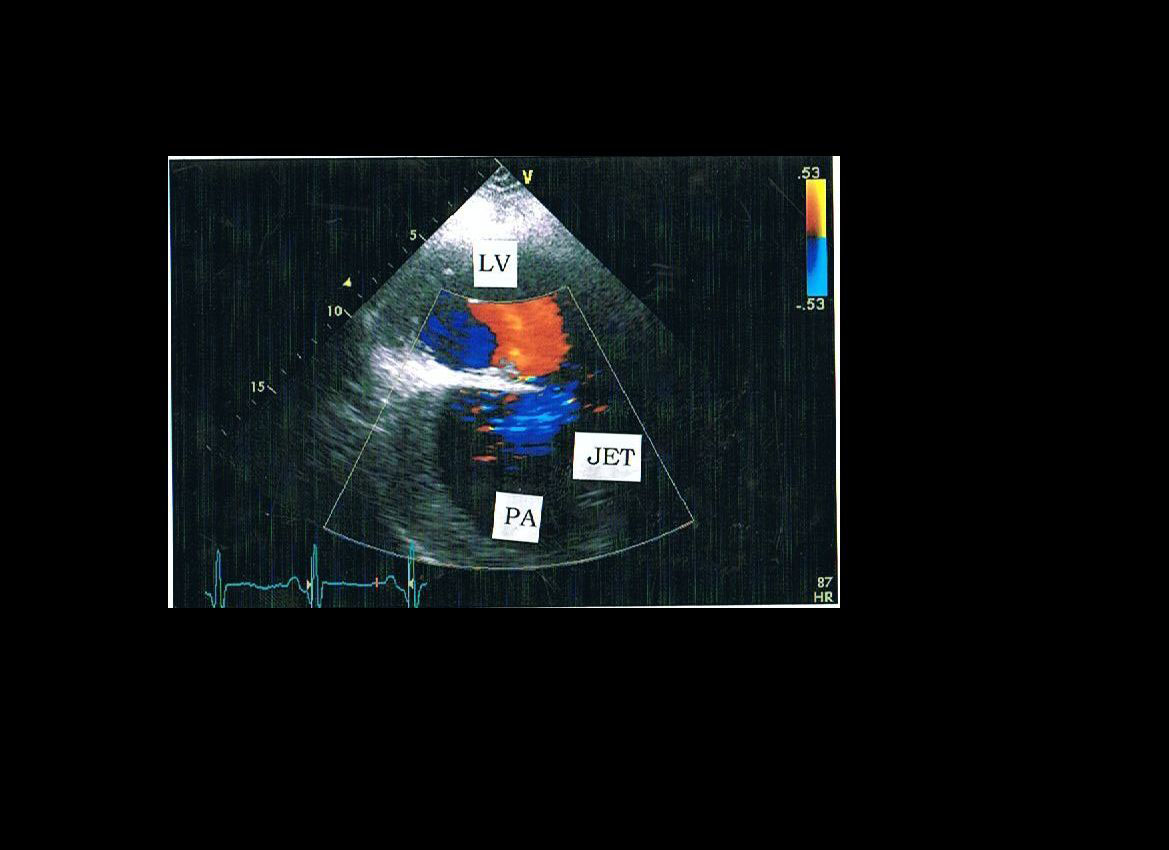 Global Akinesis: Inadvertent Left Ventricular ‚ÄúPseudoaneurysmogram‚Äù