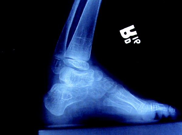 Key Insights To Treating Talipes Equinovarus