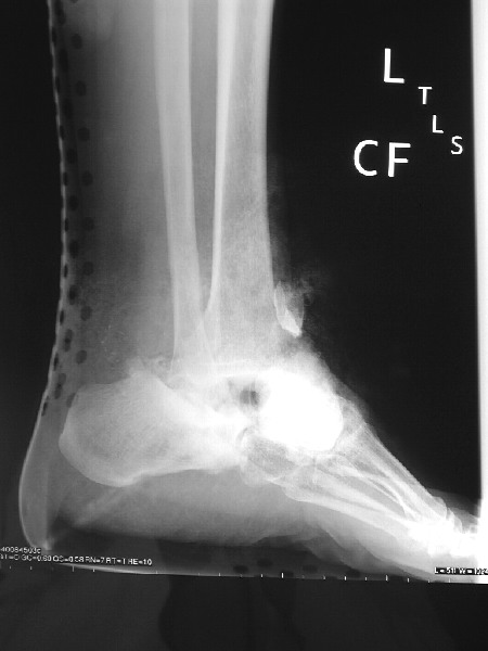 A Guide To Treating Crush Injuries