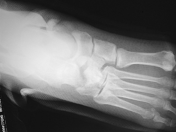 A Guide To Treating Crush Injuries