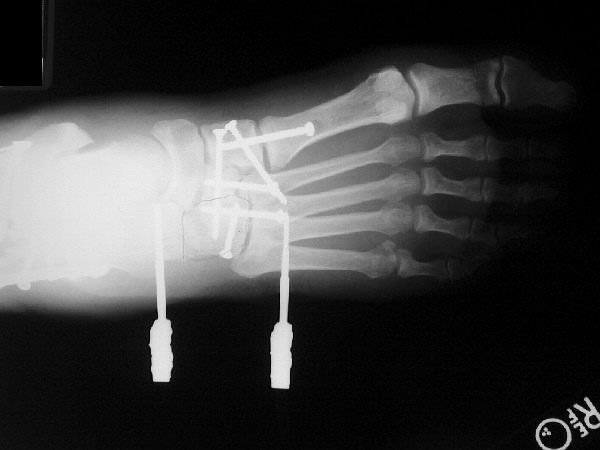 A Guide To Treating Crush Injuries