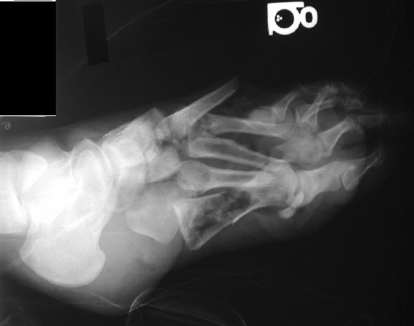 A Guide To Treating Crush Injuries