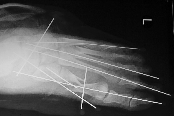 A Guide To Treating Crush Injuries