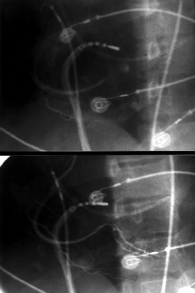 Mechanical Reperfusion of Acute Right Coronary Artery Occlusion After ...