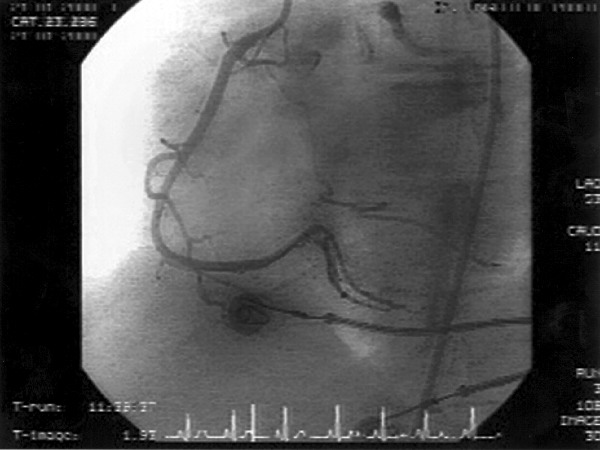 Mechanical Reperfusion of Acute Right Coronary Artery Occlusion After ...