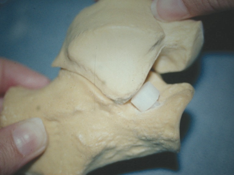Reviewing The Evolution Of Subtalar Implants