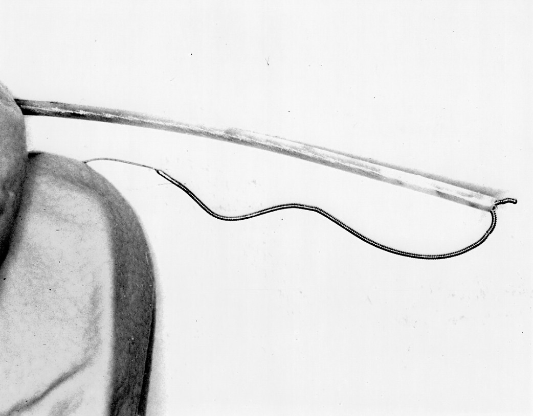 Snare Retrieval of the Distal Tip of a Fractured Rotational Atherectomy ...