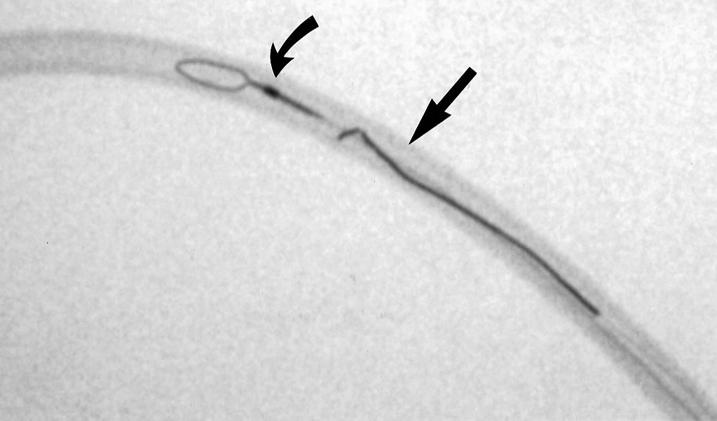 Snare Retrieval of the Distal Tip of a Fractured Rotational Atherectomy ...