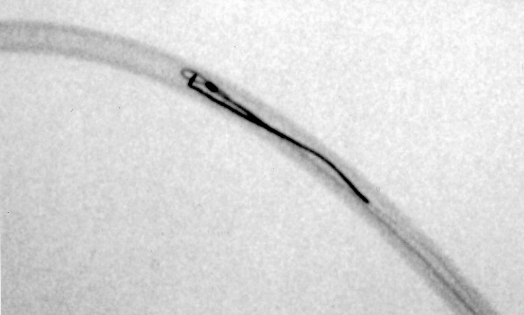 Snare Retrieval of the Distal Tip of a Fractured Rotational Atherectomy ...